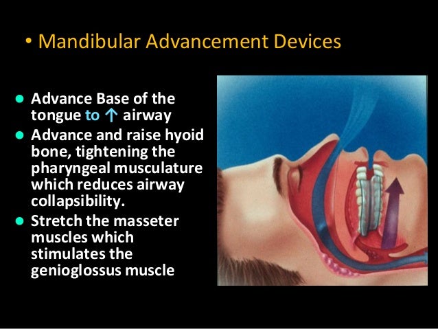 Obstructive sleep apnea