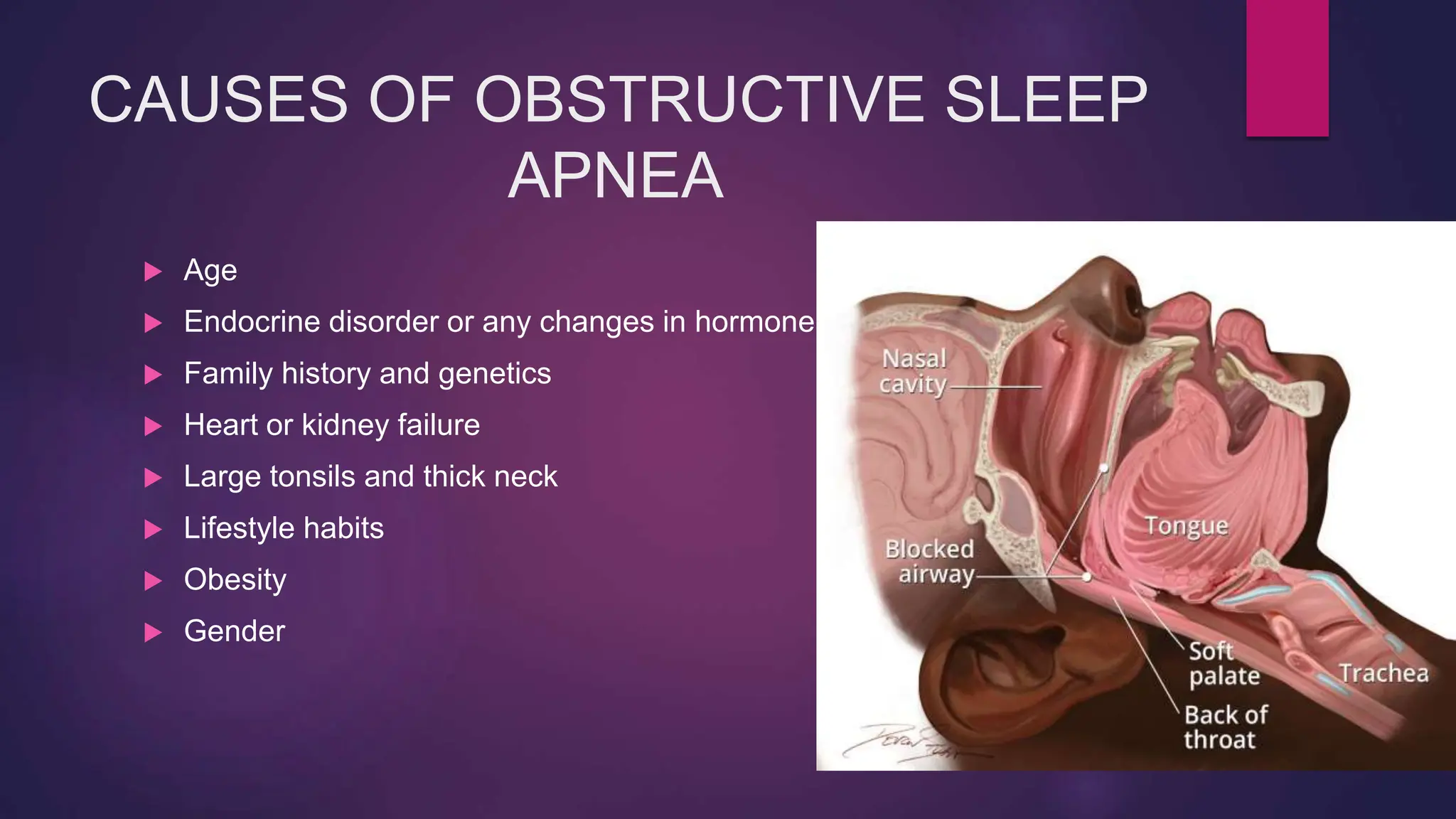 Obstructive Sleep Apnea a type of sleep disorder | PPT