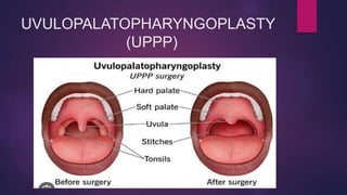 Obstructive Sleep Apnea a type of sleep disorder | PPT