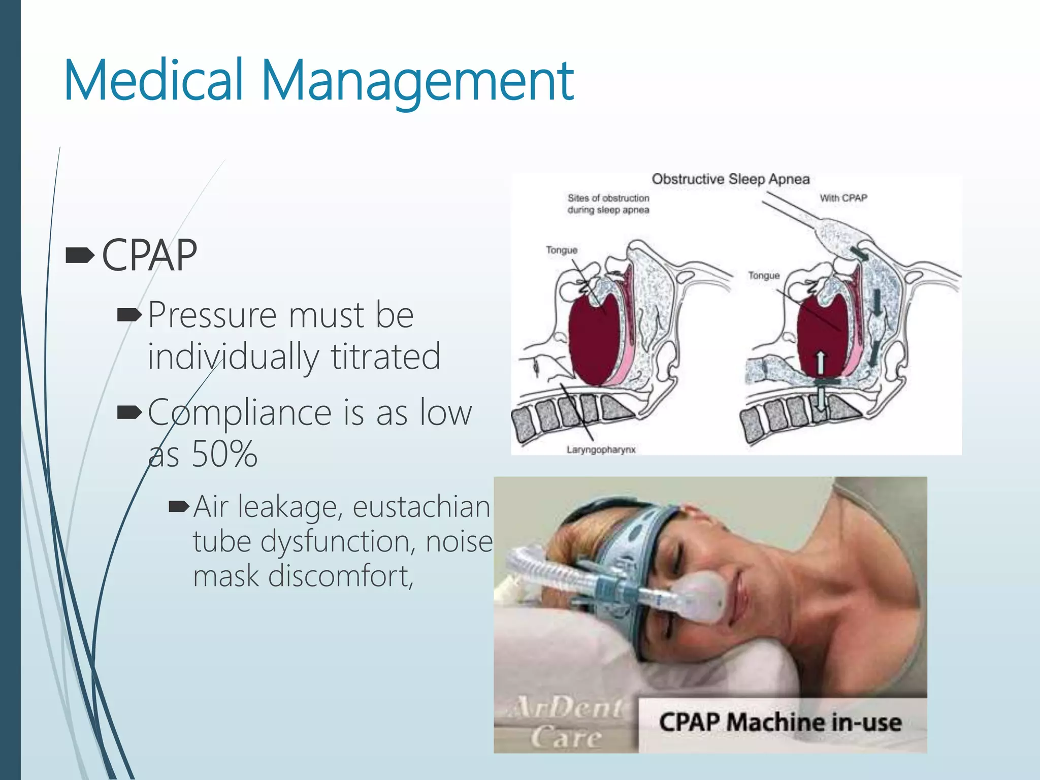Obstructive sleep apnea | PPTX
