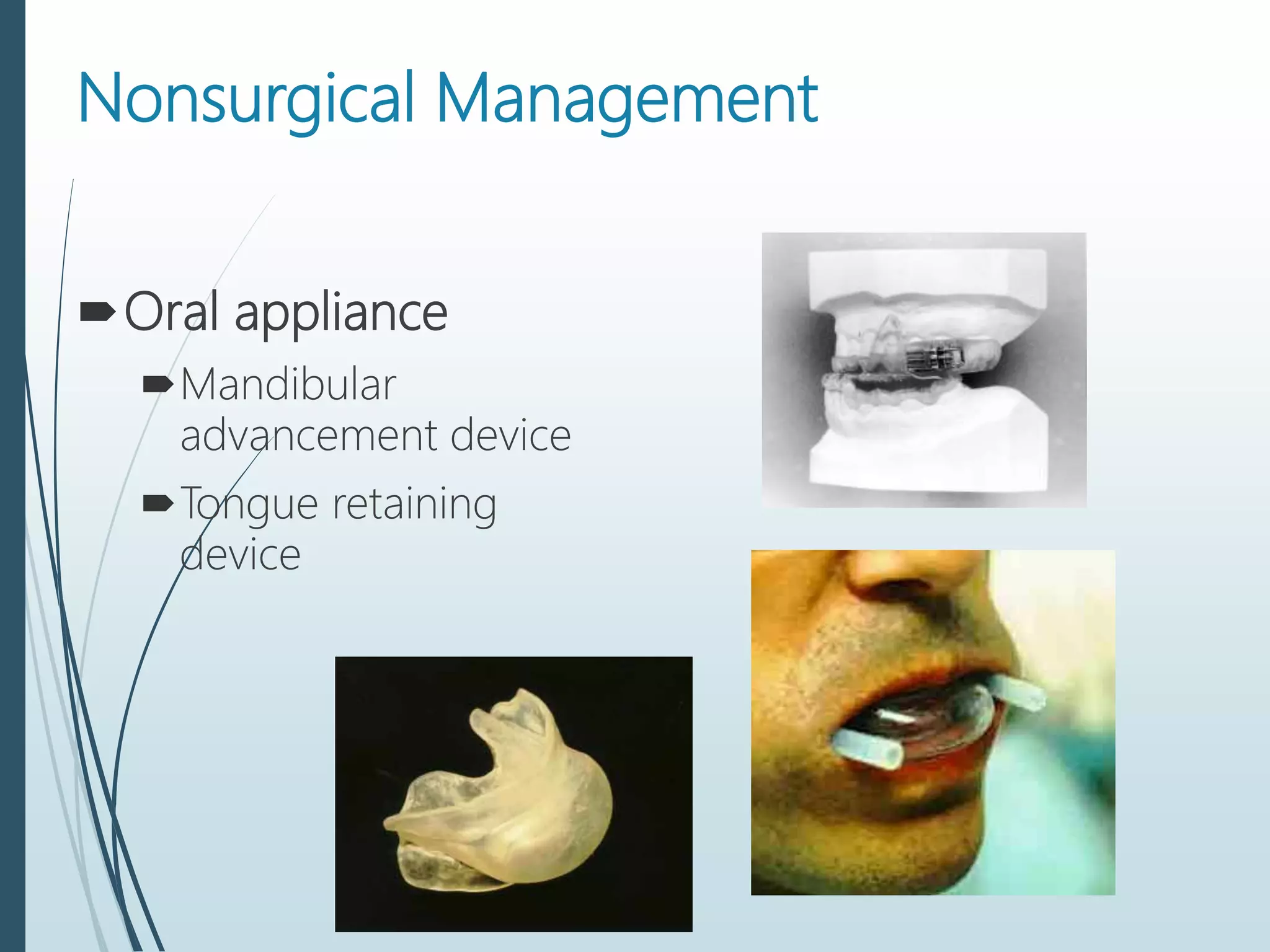 Obstructive sleep apnea | PPTX