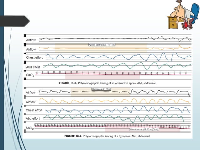 Obstructive sleep apnea | PPTX