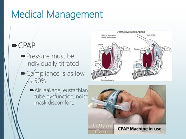 Obstructive sleep apnea | PPTX