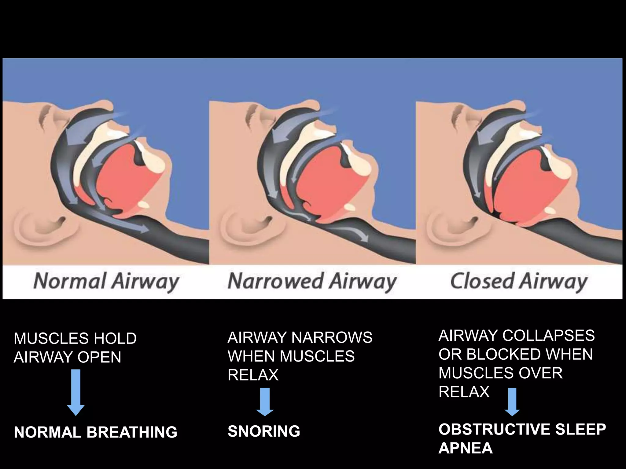 OBSTRUCTIVE SLEEP APNEA.ppt