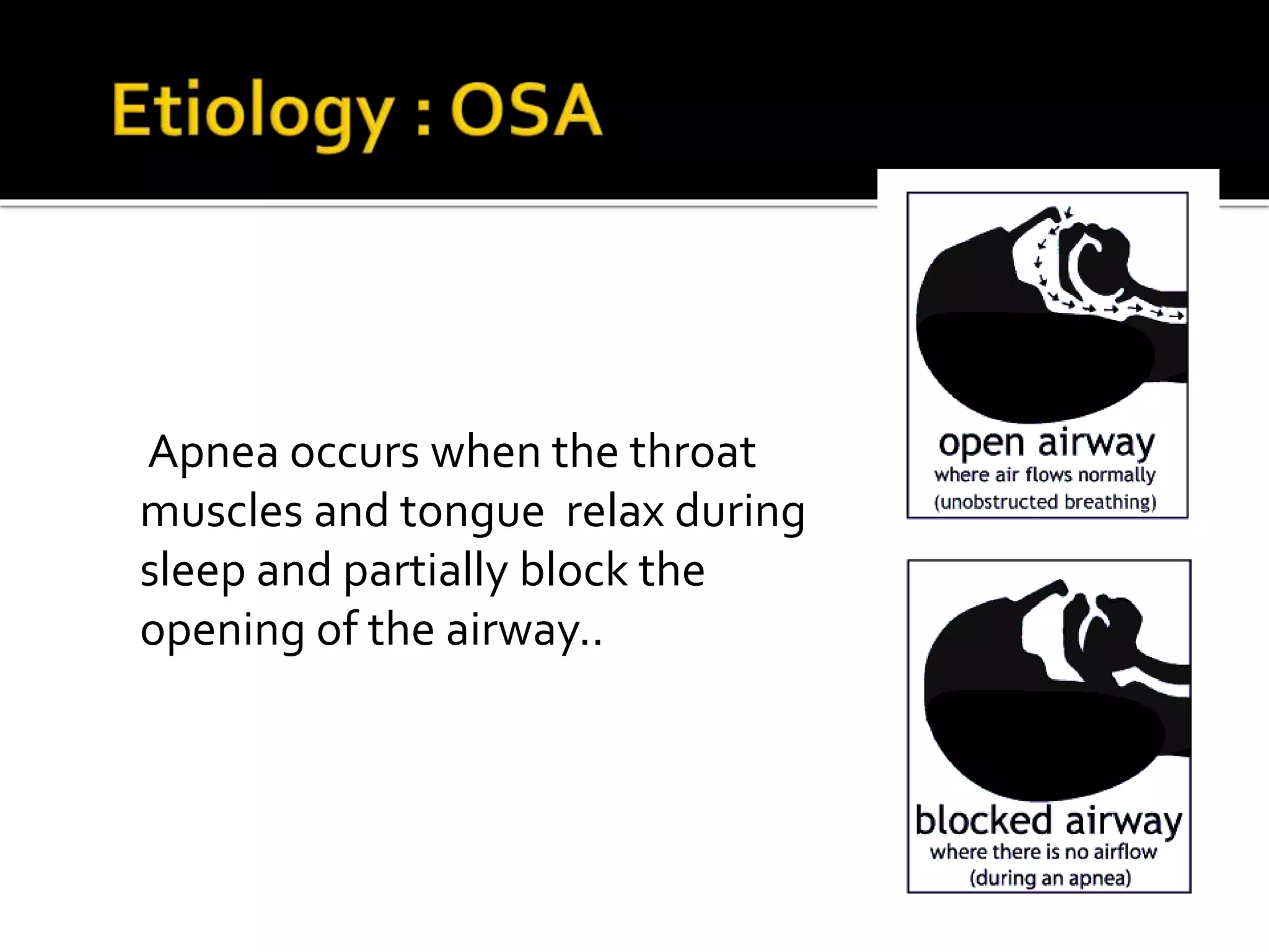 OBSTRUCTIVE SLEEP APNEA.ppt