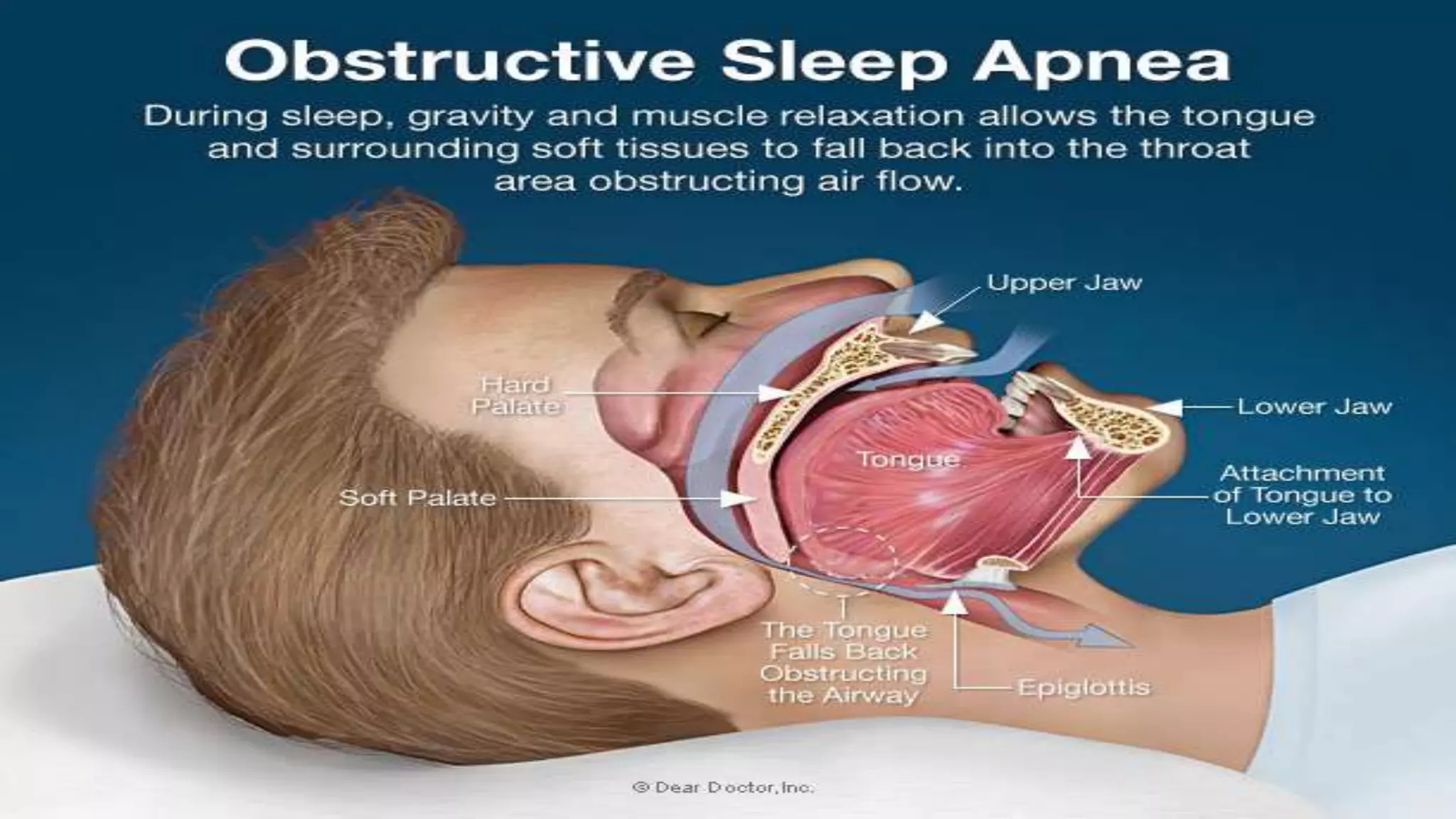 Obstructive Sleep Apnea And Orthognathic Surgery.pptx | Ear, Nose and Throat Conditions ...