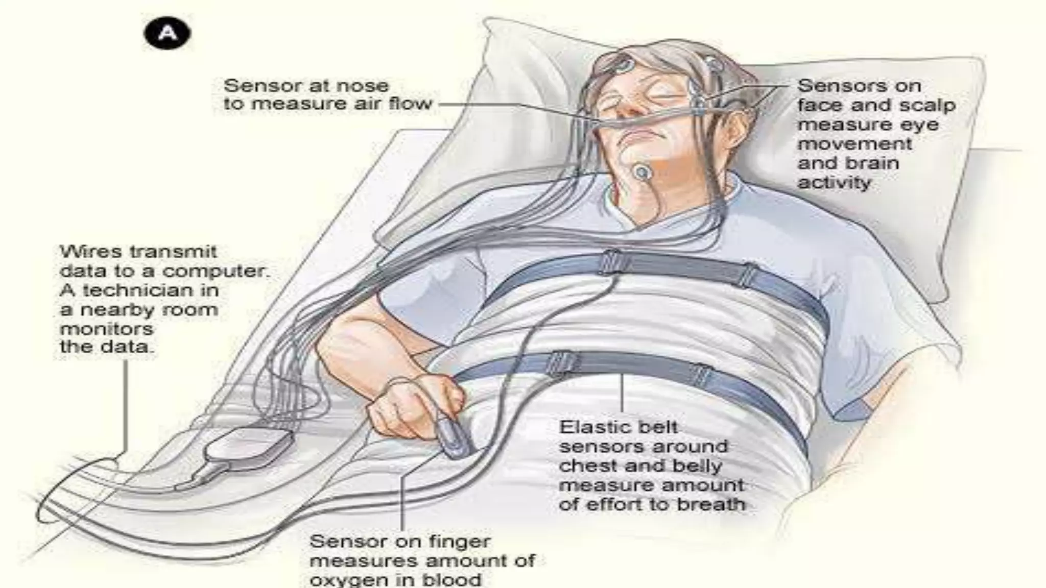 Obstructive Sleep Apnea And Orthognathic Surgery.pptx | Ear, Nose and ...