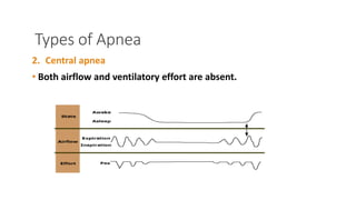 Obstructive Sleep Apnea And Orthognathic Surgery.pptx