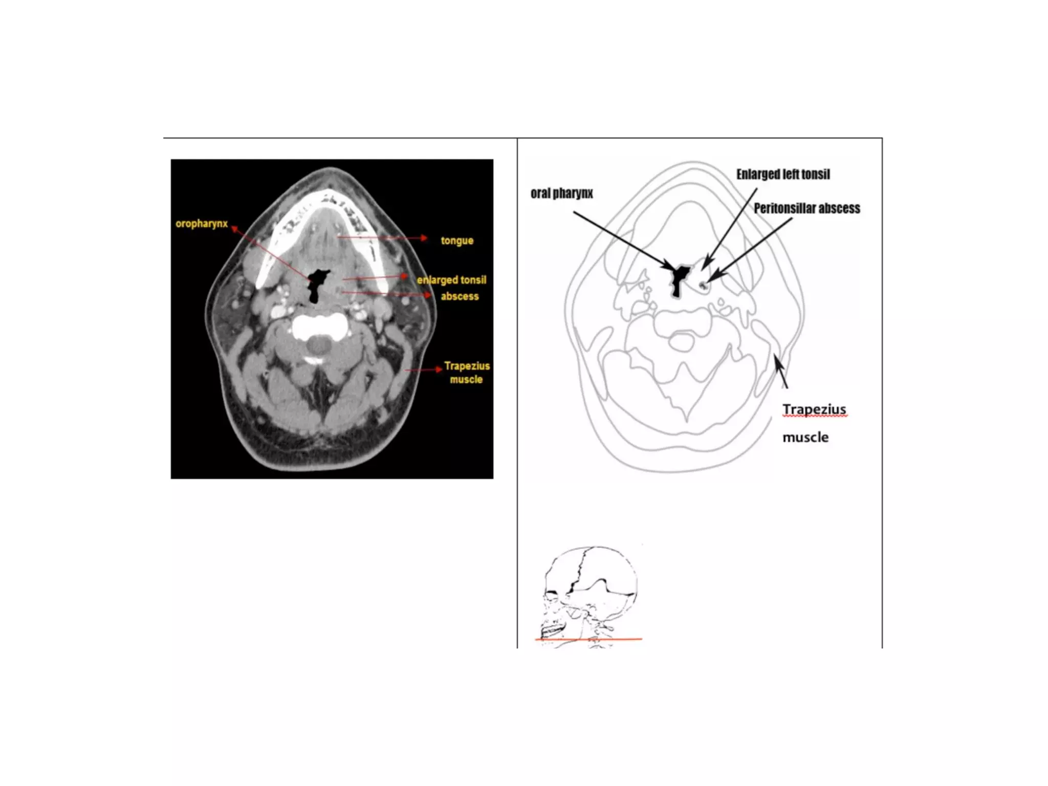 Obstructive sleep apnea (osa)The relationship of airway obstruction and ...
