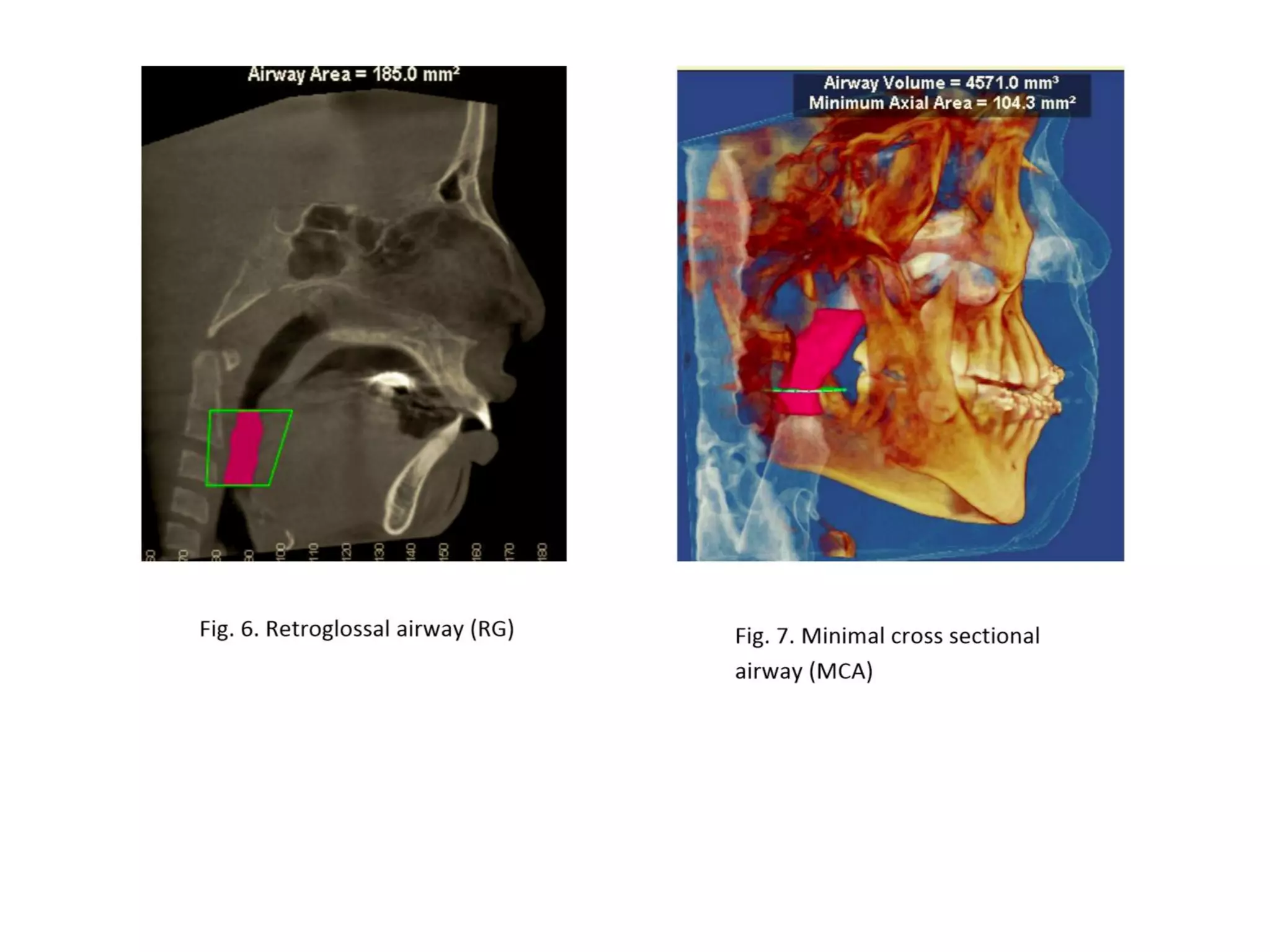 Obstructive sleep apnea (osa)The relationship of airway obstruction and ...