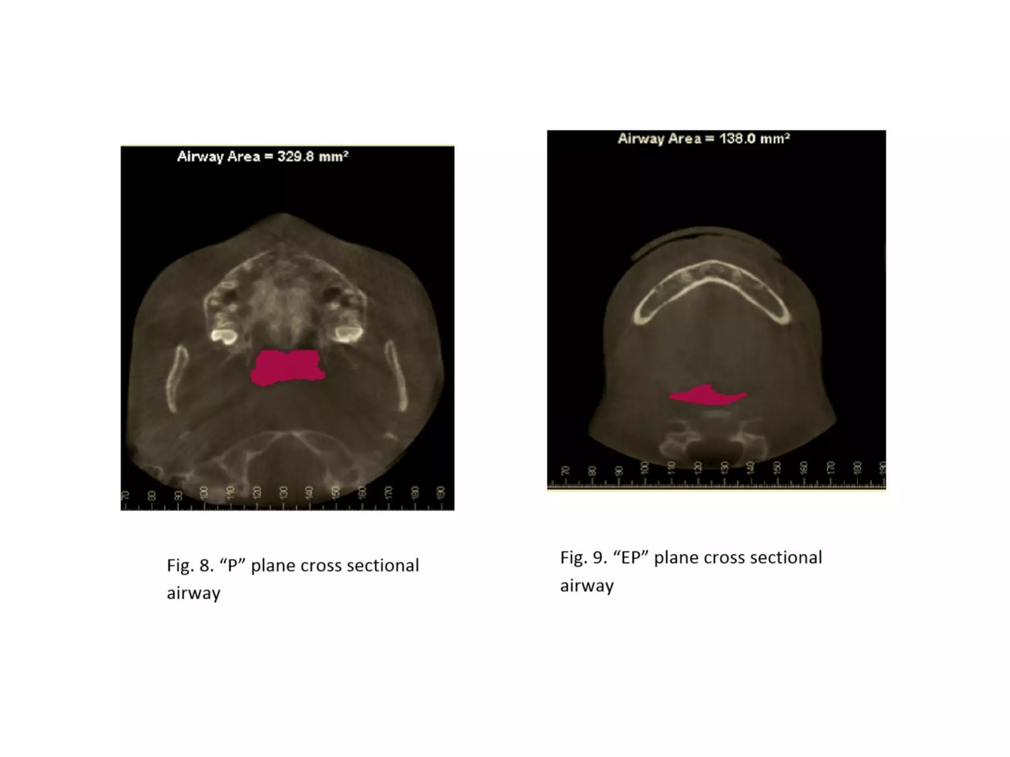 Obstructive sleep apnea (osa)The relationship of airway obstruction and ...