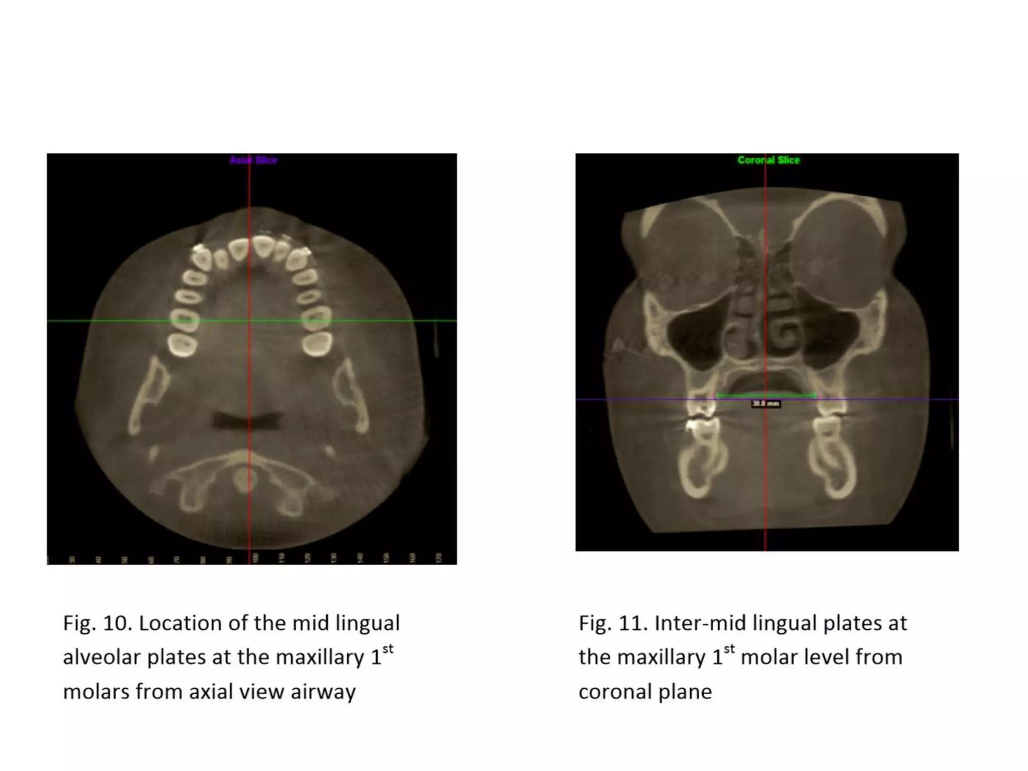 Obstructive sleep apnea (osa)The relationship of airway obstruction and ...