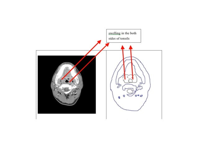Obstructive sleep apnea (osa)The relationship of airway obstruction and ...