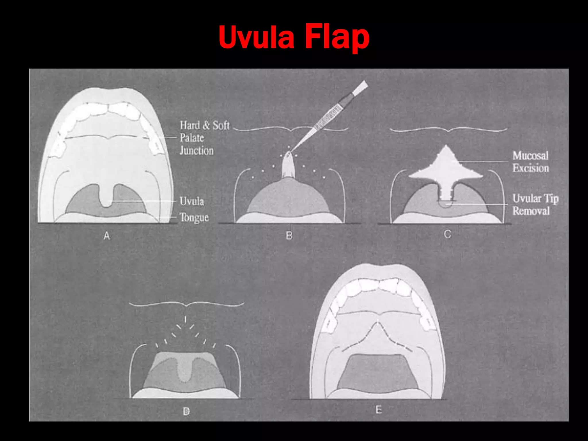 Obstructive sleep apnea syndrome | PPT