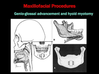 Obstructive sleep apnea syndrome | PPT