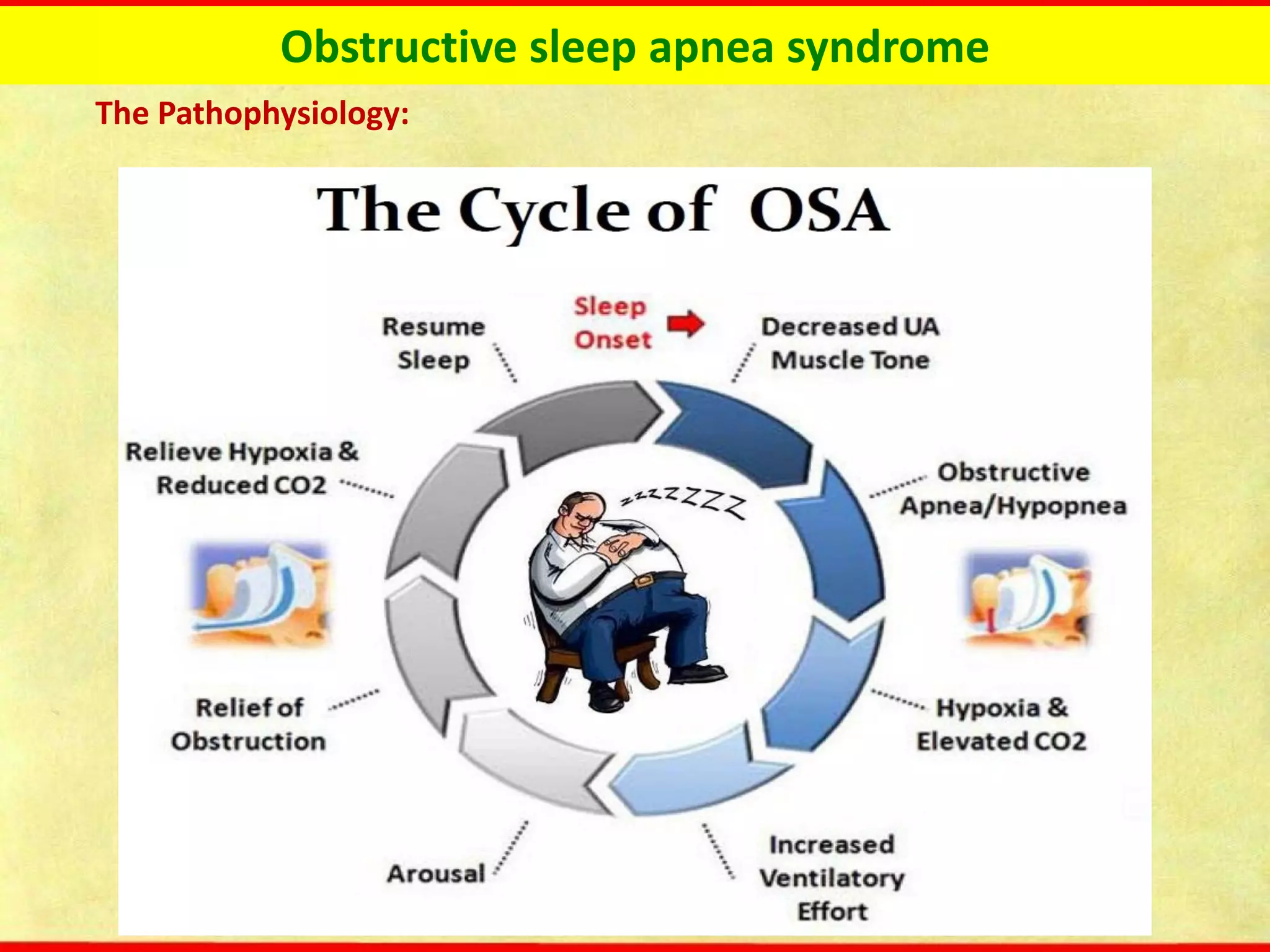 Obstructive sleep apnea syndrome.pdf