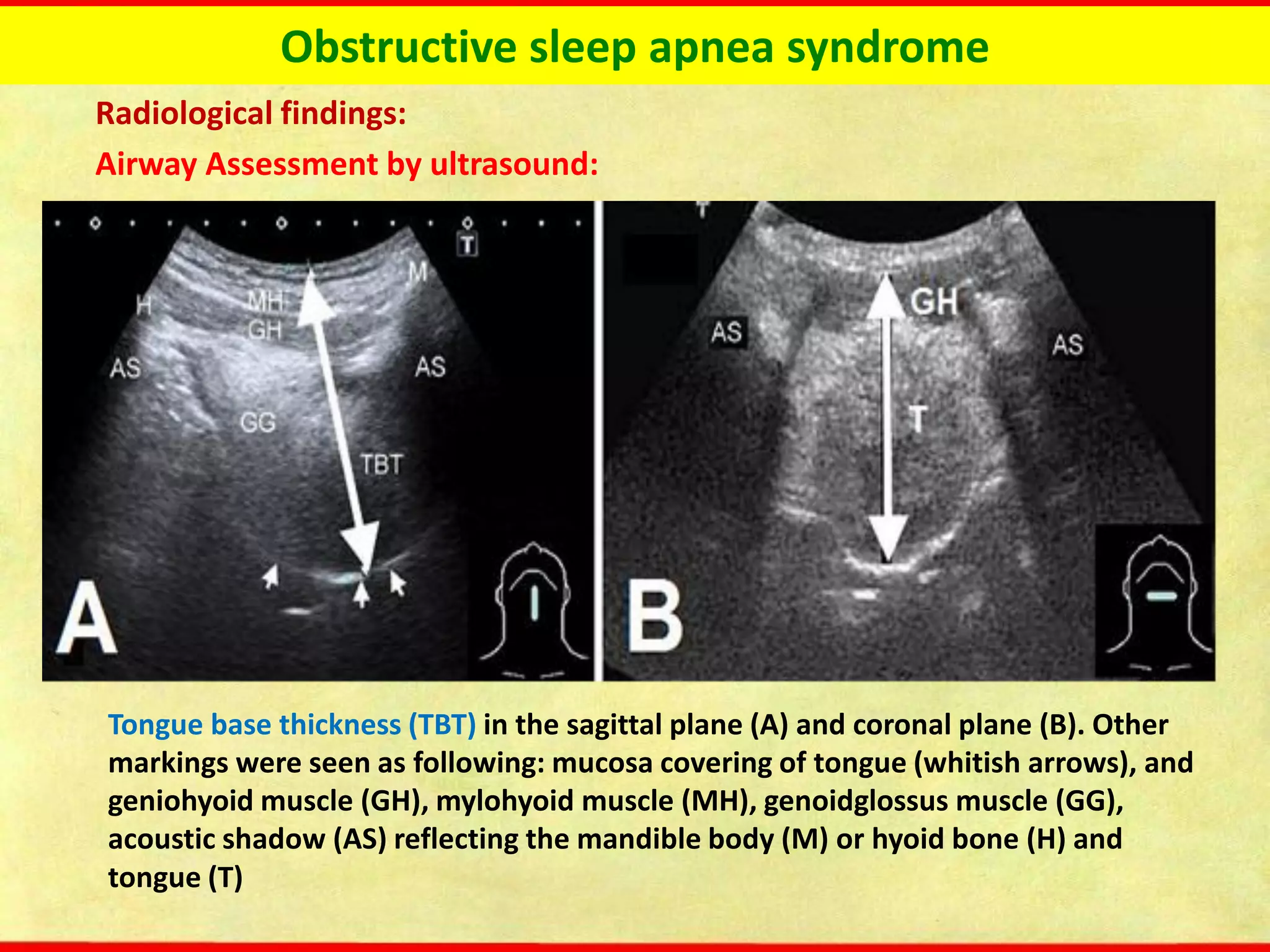 Obstructive sleep apnea syndrome.pdf