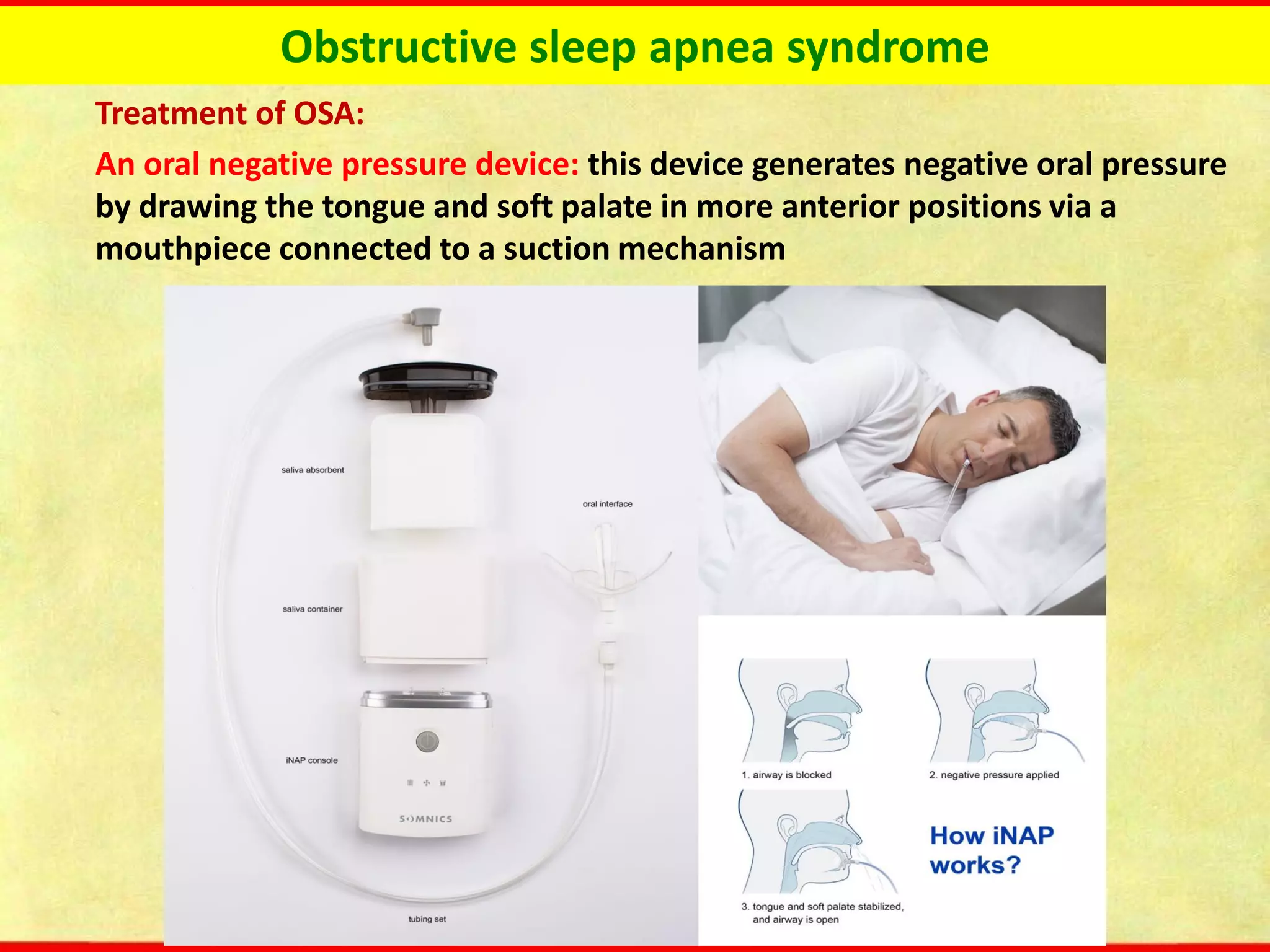 Obstructive sleep apnea syndrome.pdf