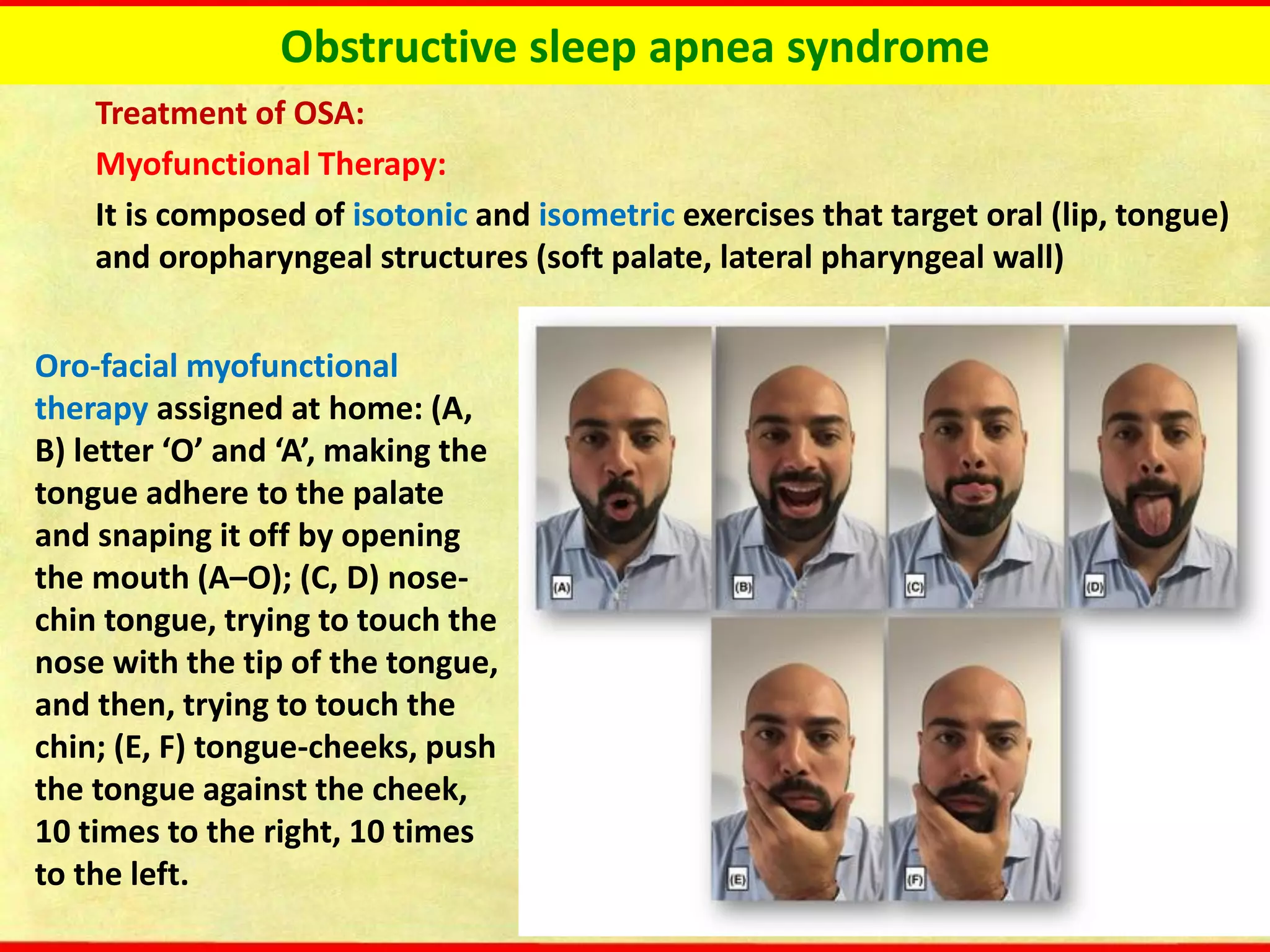 Obstructive sleep apnea syndrome.pdf