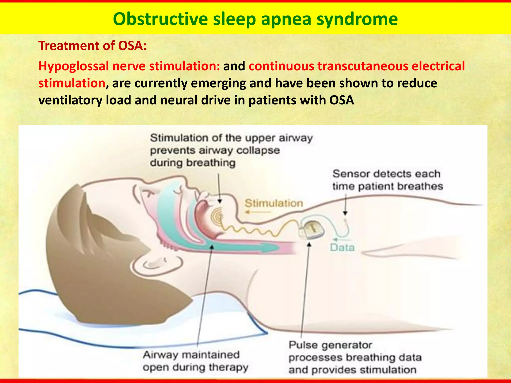 Obstructive sleep apnea syndrome.pdf