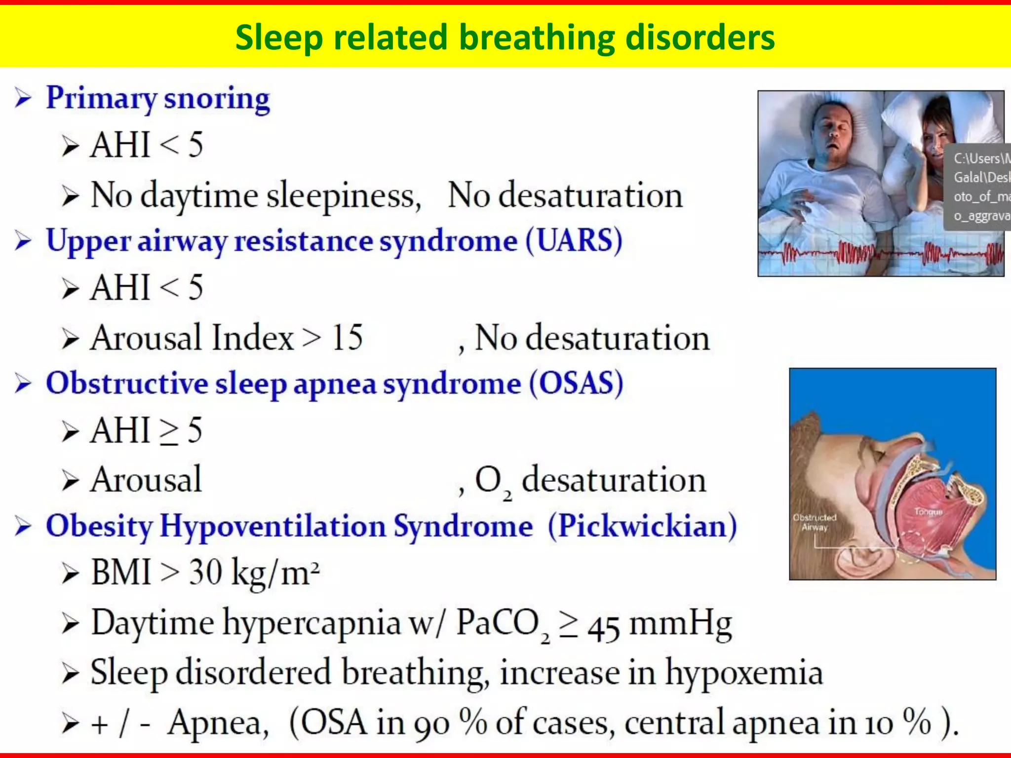 Obstructive sleep apnea syndrome.pdf