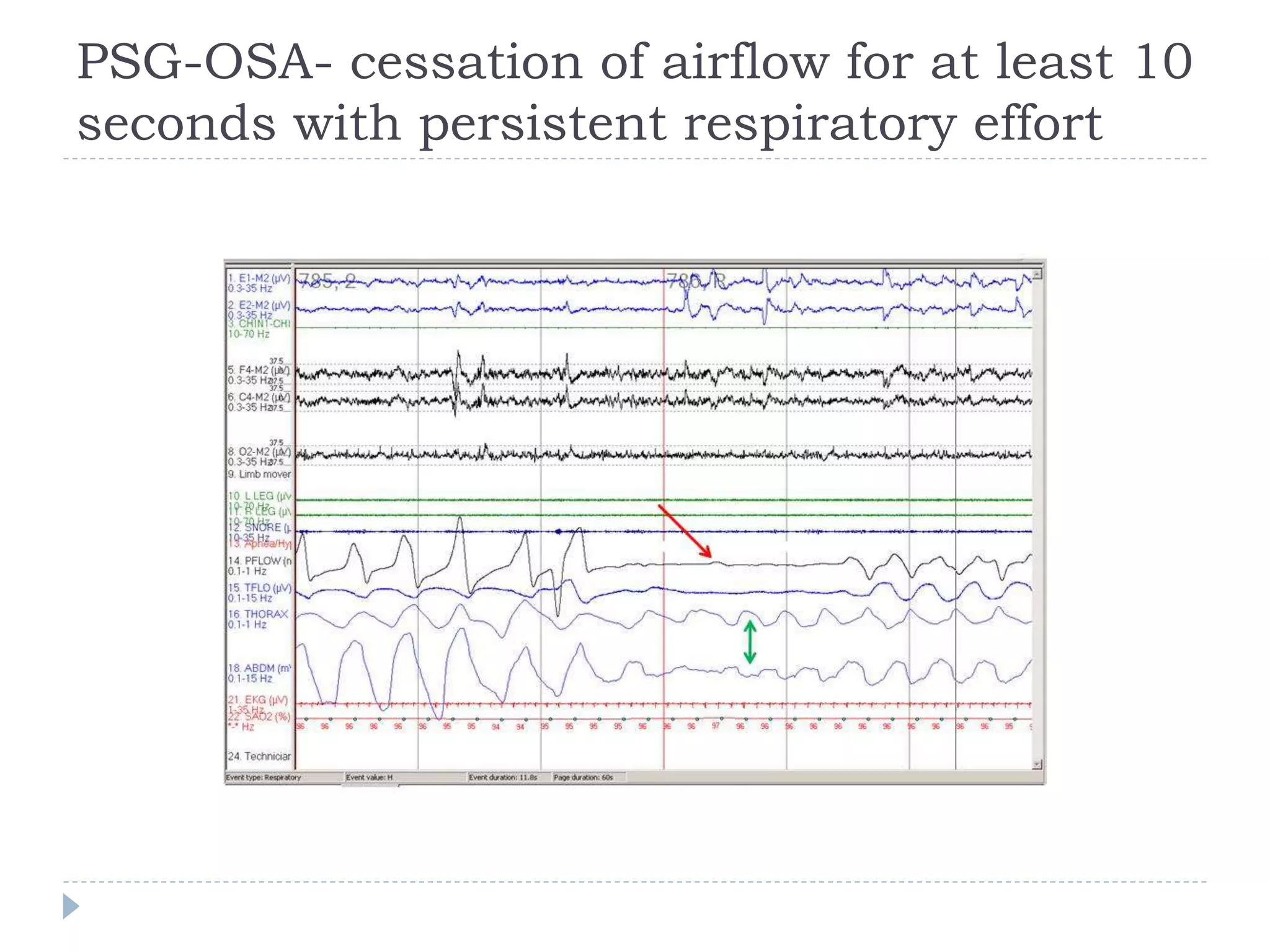 Obstructive sleep apnoea - clinical approach to a patient/ AASM ...