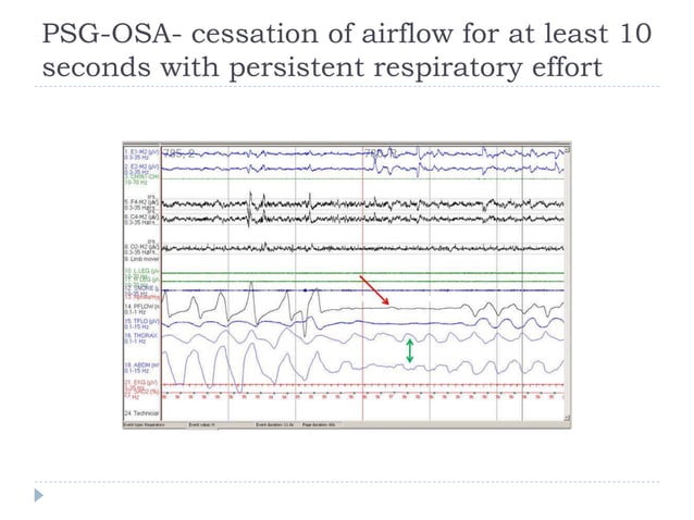 Obstructive sleep apnoea - clinical approach to a patient/ AASM ...
