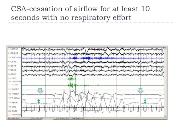 Obstructive sleep apnoea - clinical approach to a patient/ AASM ...