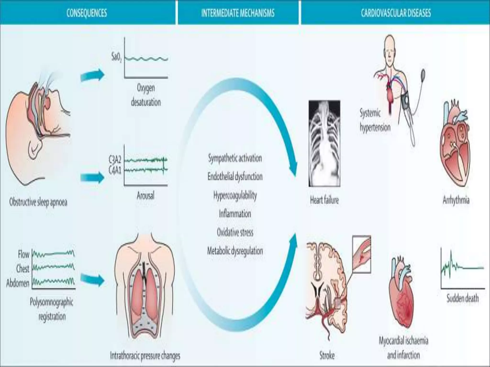 Obstructive sleep apnoea | PPTX