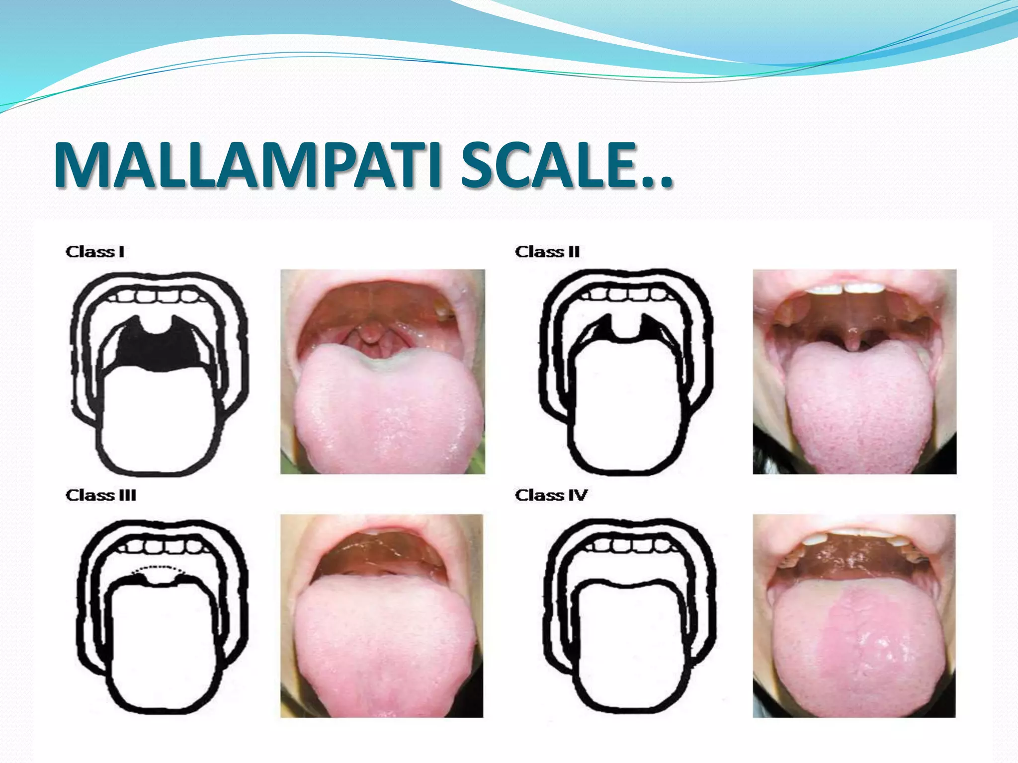 Obstructive sleep apnoea | PPTX