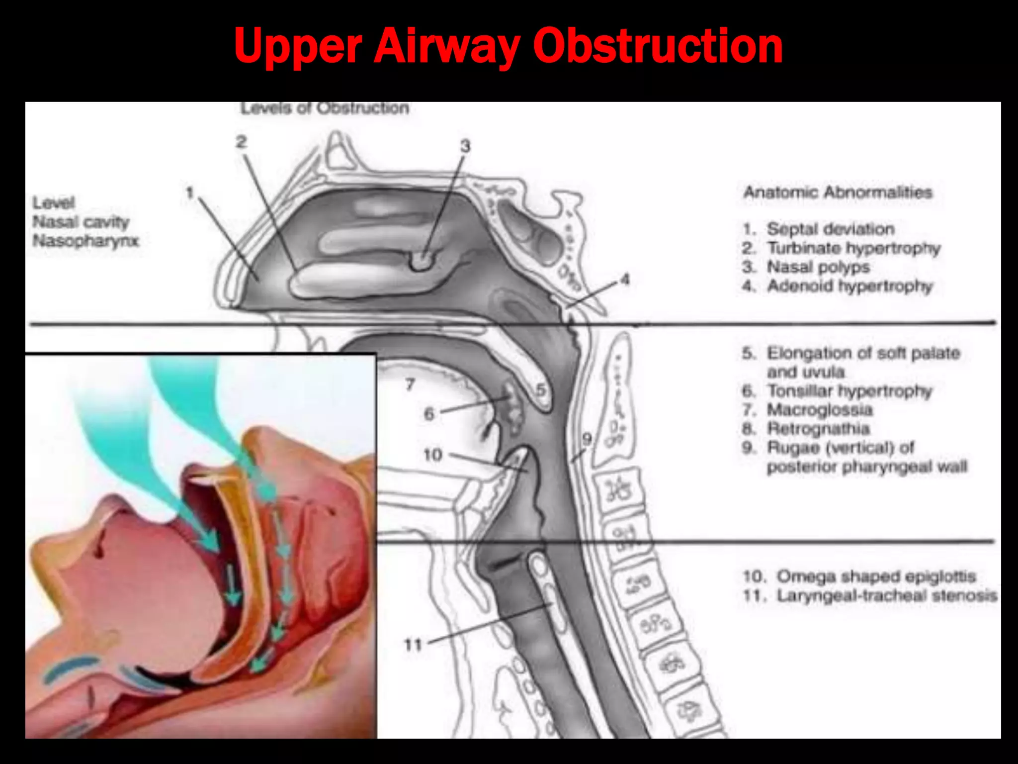 Obstructive Sleep Apnoea Syndromeosas Ppt 3097