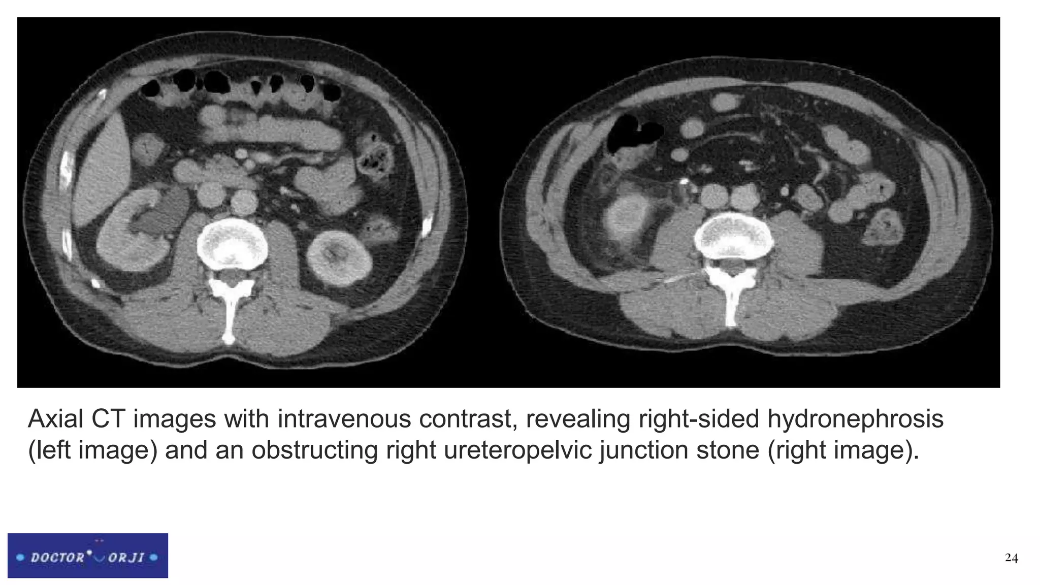 Obstructive Uropathy | PPTX