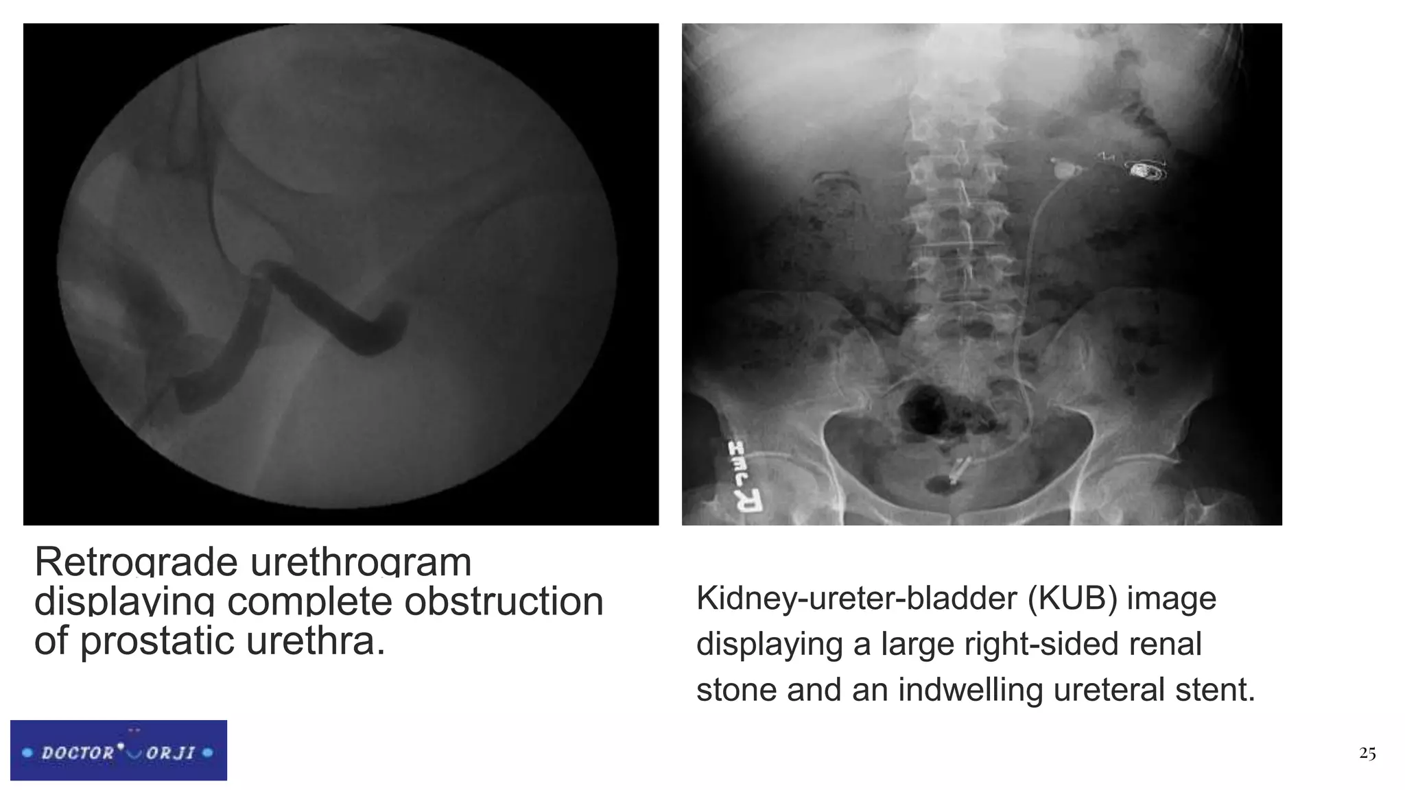 Obstructive Uropathy | PPTX