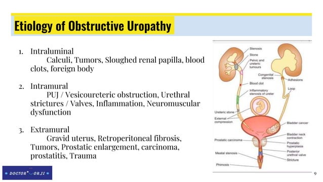 Obstructive Uropathy | PPTX