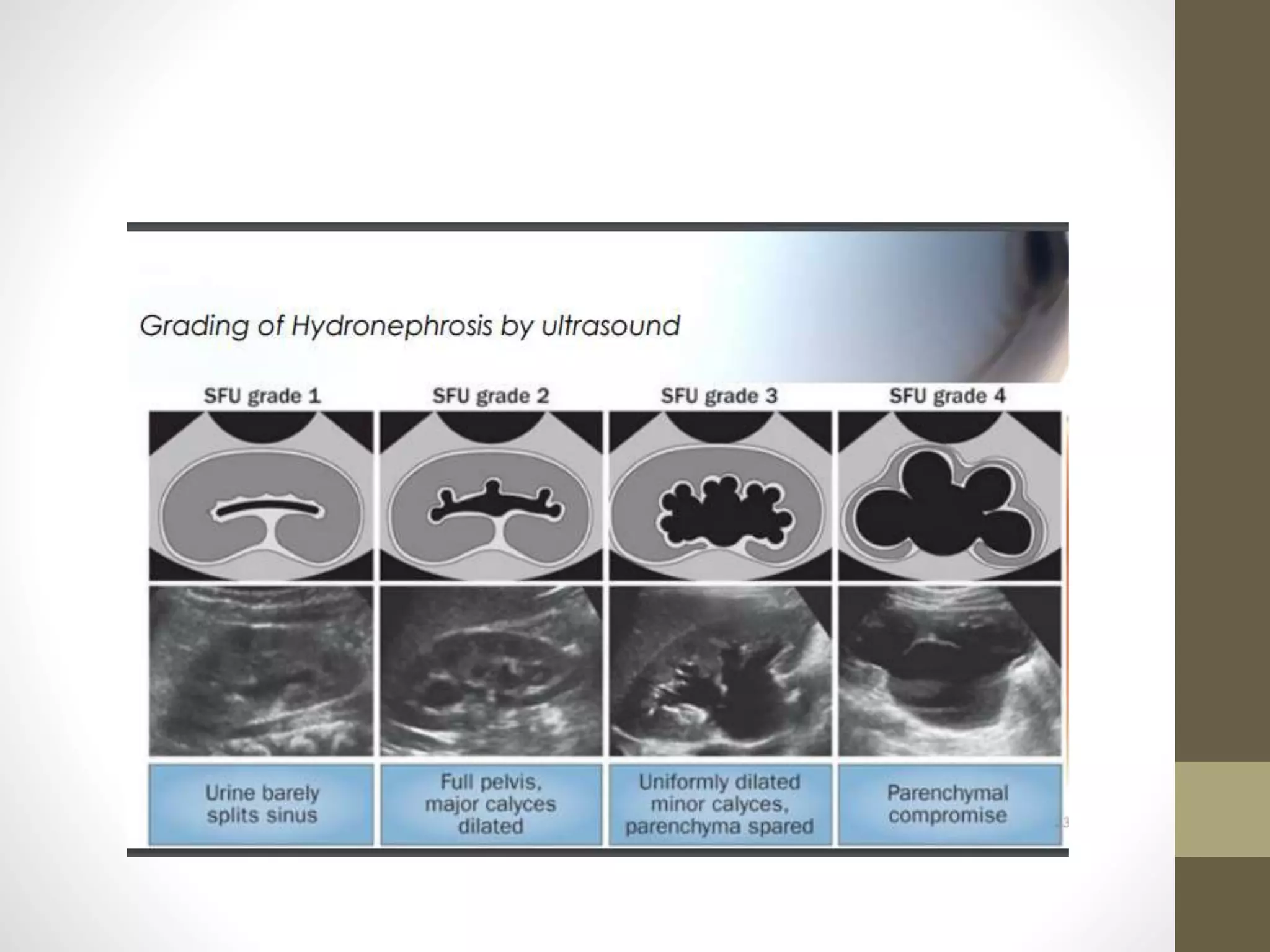 Obstructive Uropathy.pptx