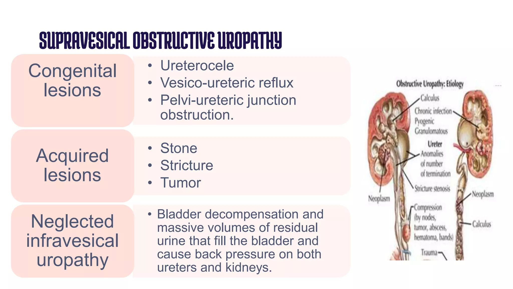 obstructive uropathy.pptx