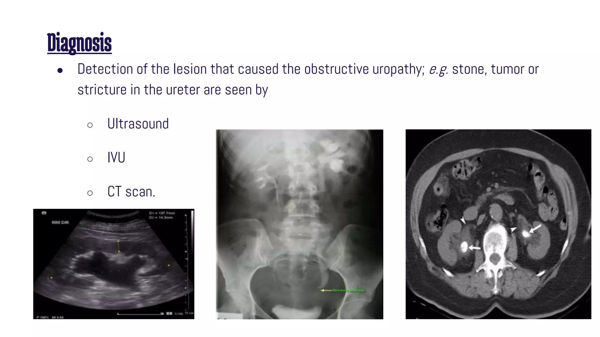 obstructive uropathy.pptx
