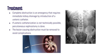 obstructive uropathy.pptx