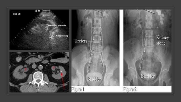 obstructive uropathy.pdf