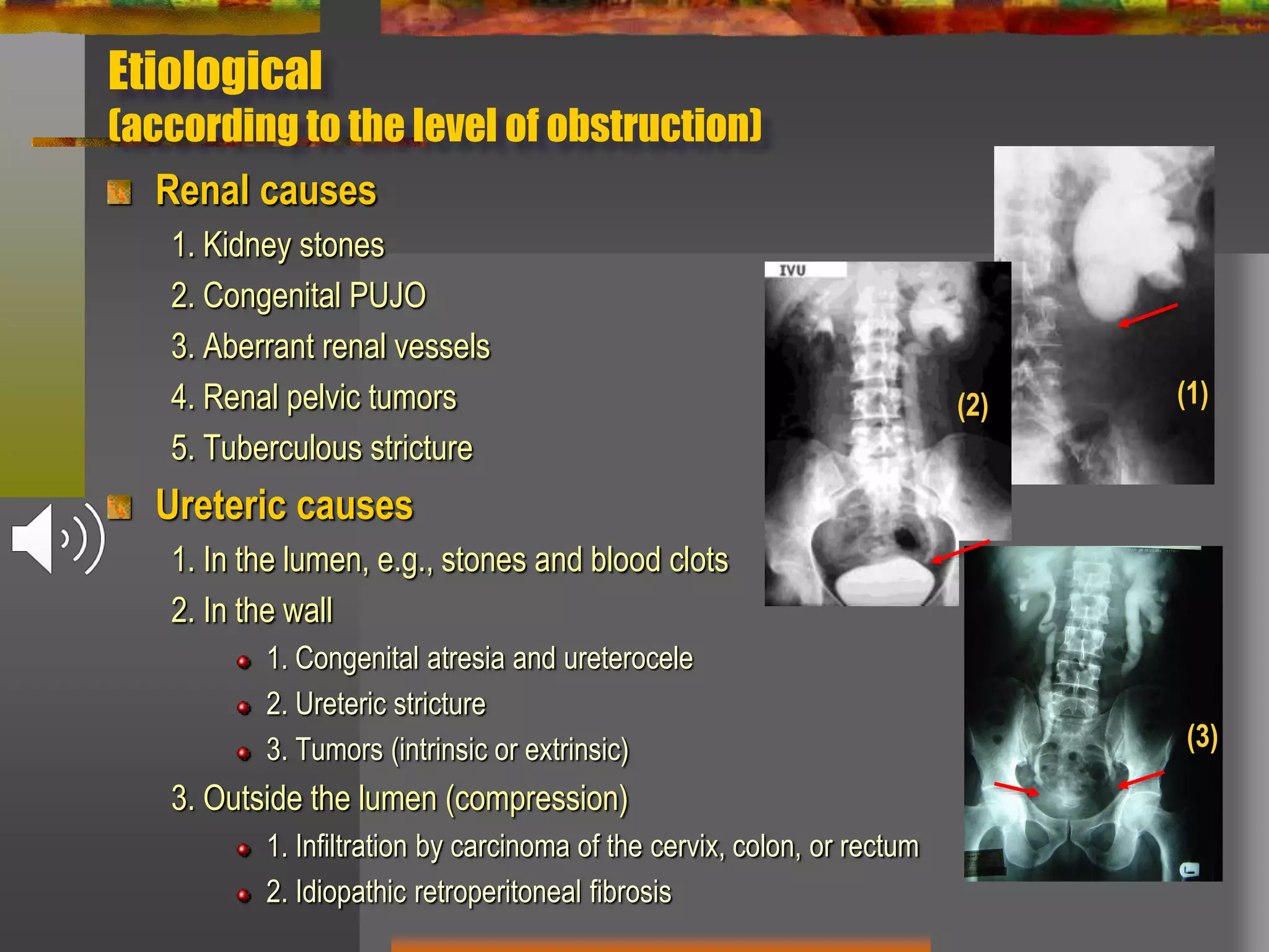 Obstructive Uropathy Online Pptx