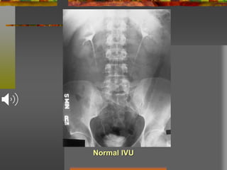 Obstructive Uropathy "online" | PPTX