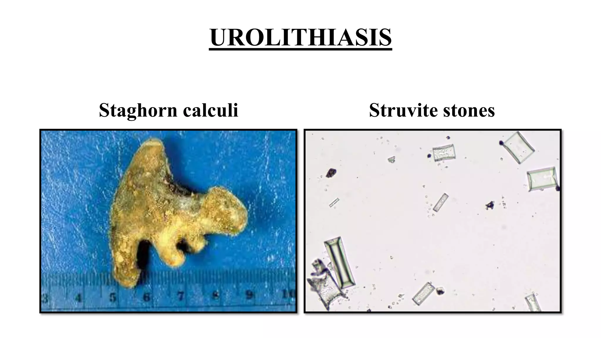 OBSTRUCTIVE UROPATHY PPT.pptx