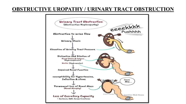 OBSTRUCTIVE UROPATHY PPT.pptx