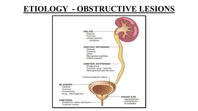 OBSTRUCTIVE UROPATHY PPT.pptx