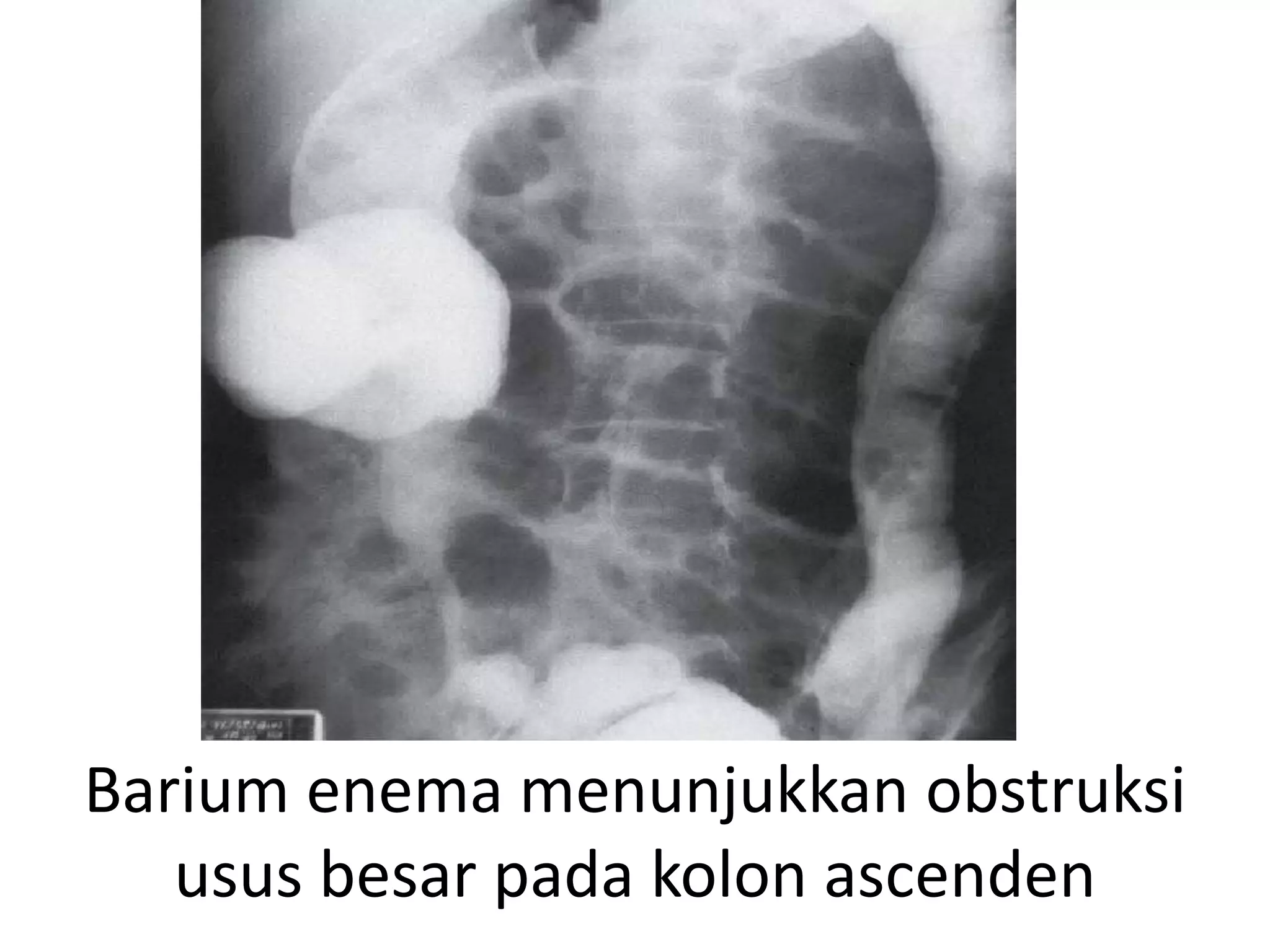 Obstruksi Usus Mekanis PPT.pptx