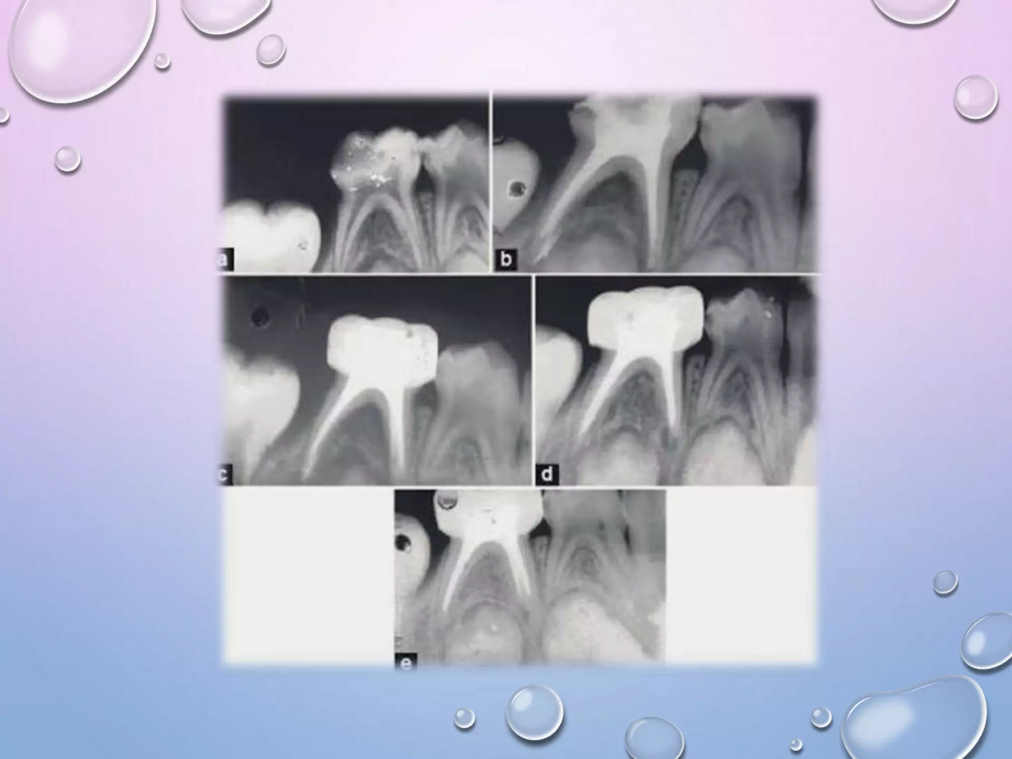 Obturating materials for primary teeth | PPTX