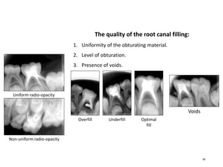 OBTURATING MATERIALS AND OBTURATION SYSTEMS IN PRIMARY TEETH | PPT