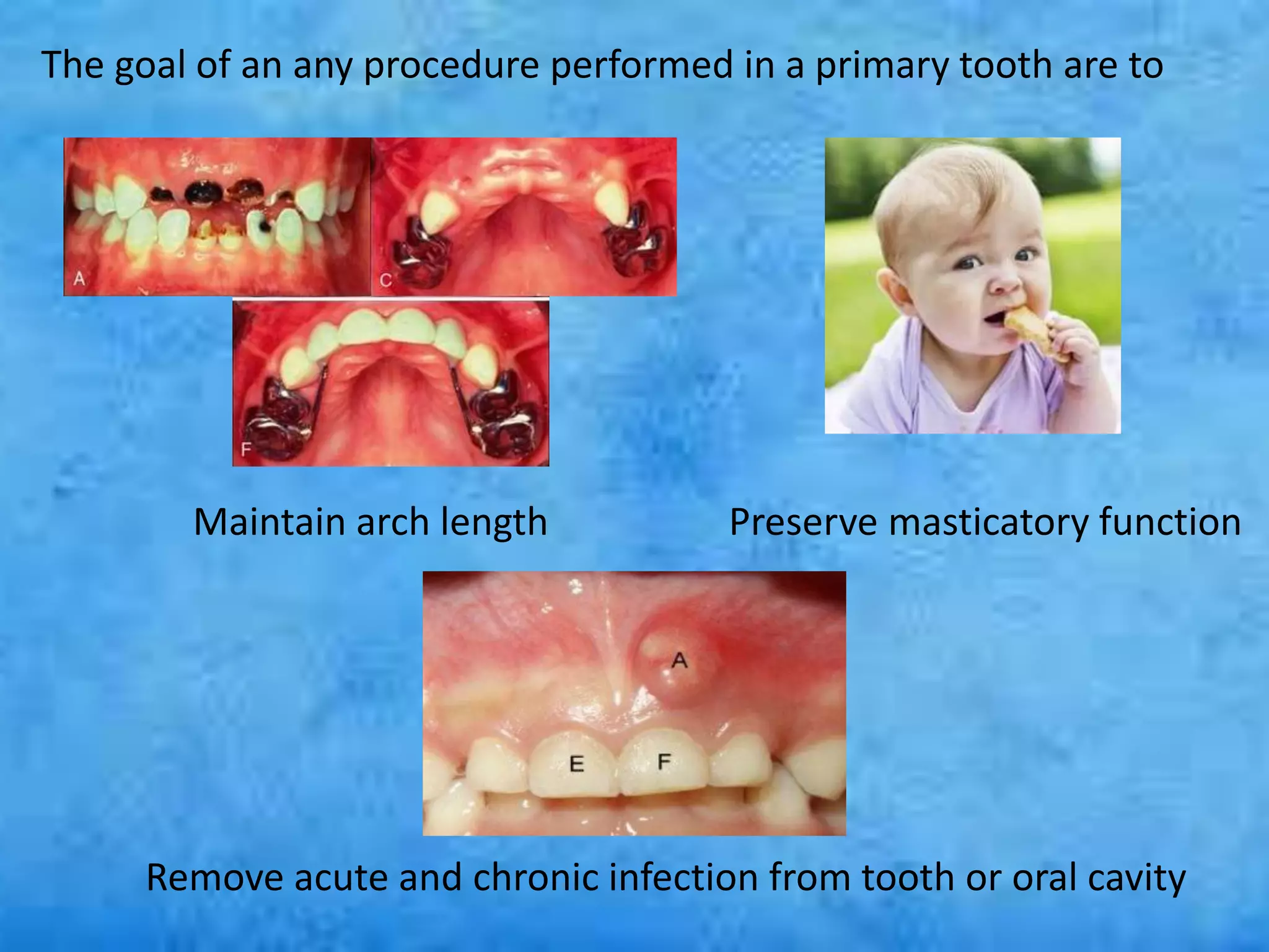 Obturating materials for primary tooth | PPTX