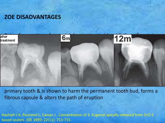 Obturating materials for primary tooth | PPTX | Dental Health ...