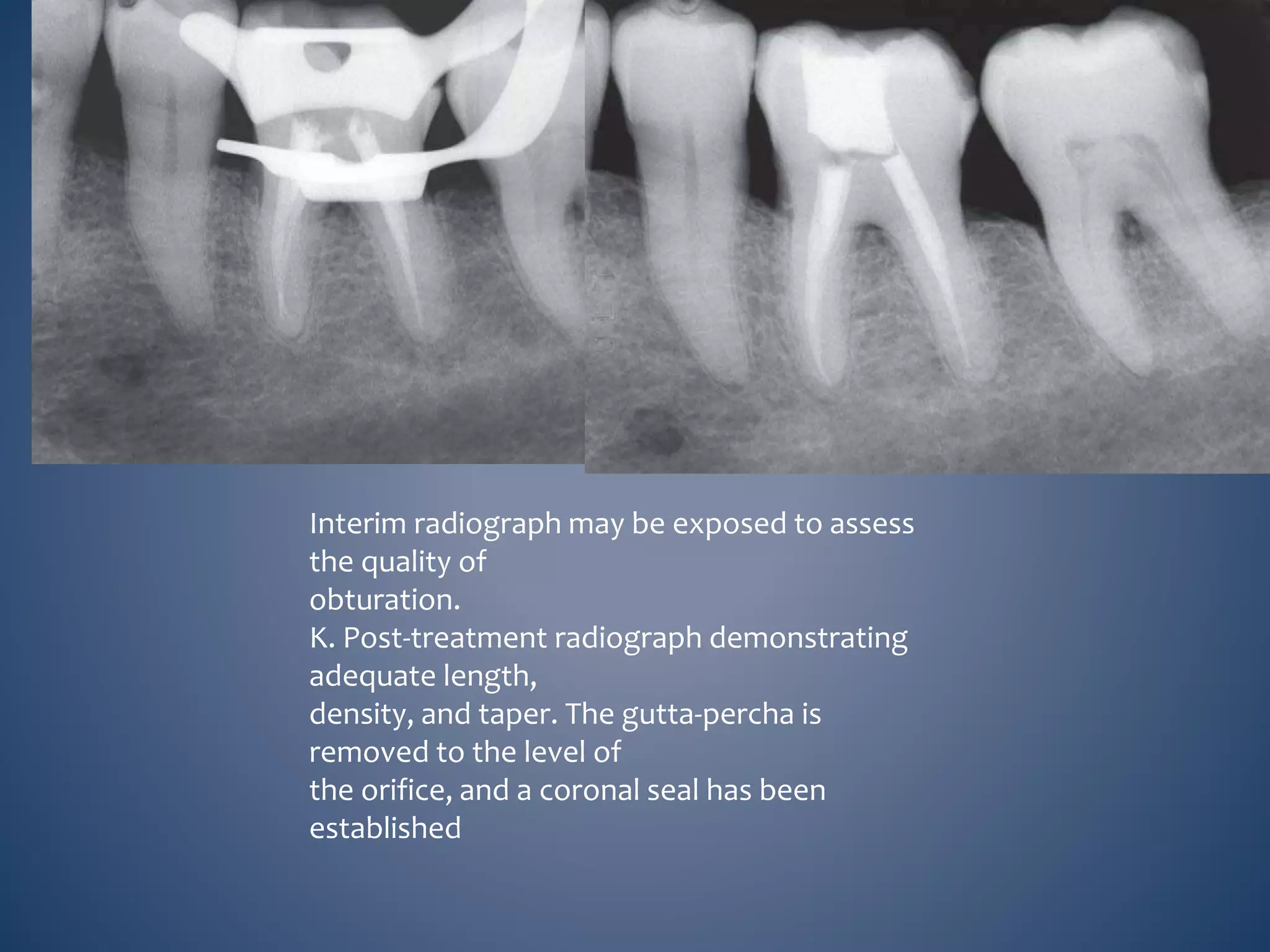 OBTURATING TECHNIQUES.pptx | Dental Health | Diseases and Conditions